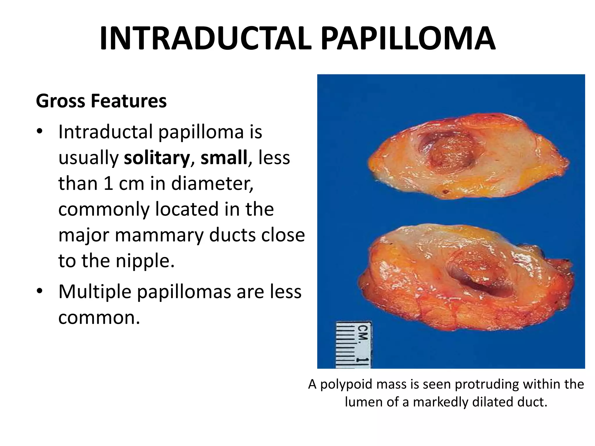 Tumors of the breast | PPTX
