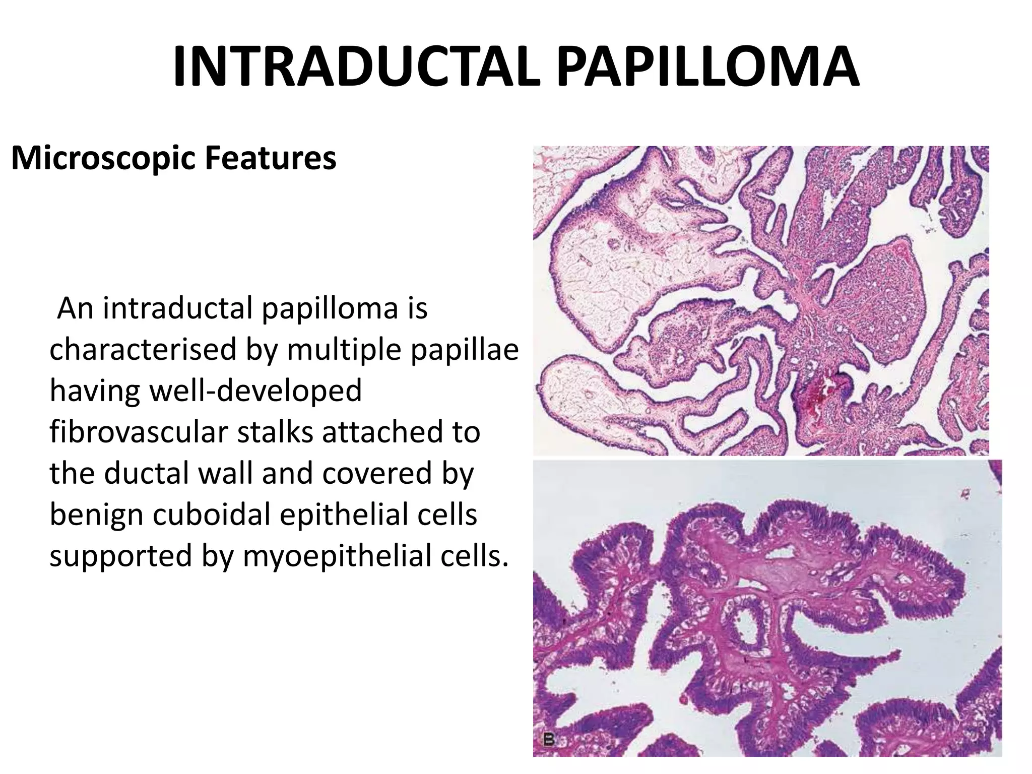 Tumors of the breast | PPTX