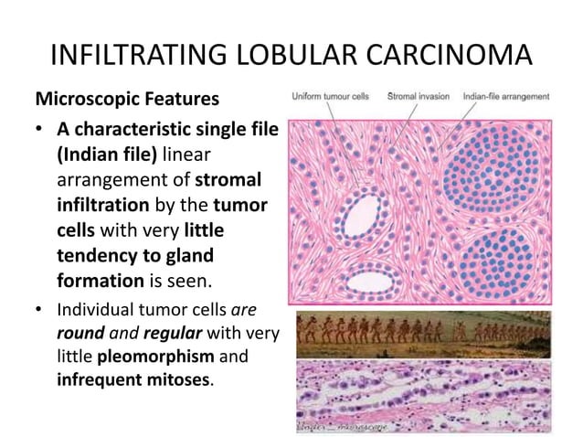 Tumors of the breast | PPTX