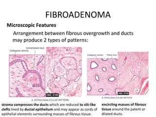 Tumors of the breast | PPTX