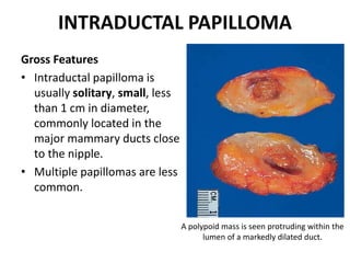 Tumors of the breast | PPTX
