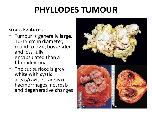 Tumors of the breast
