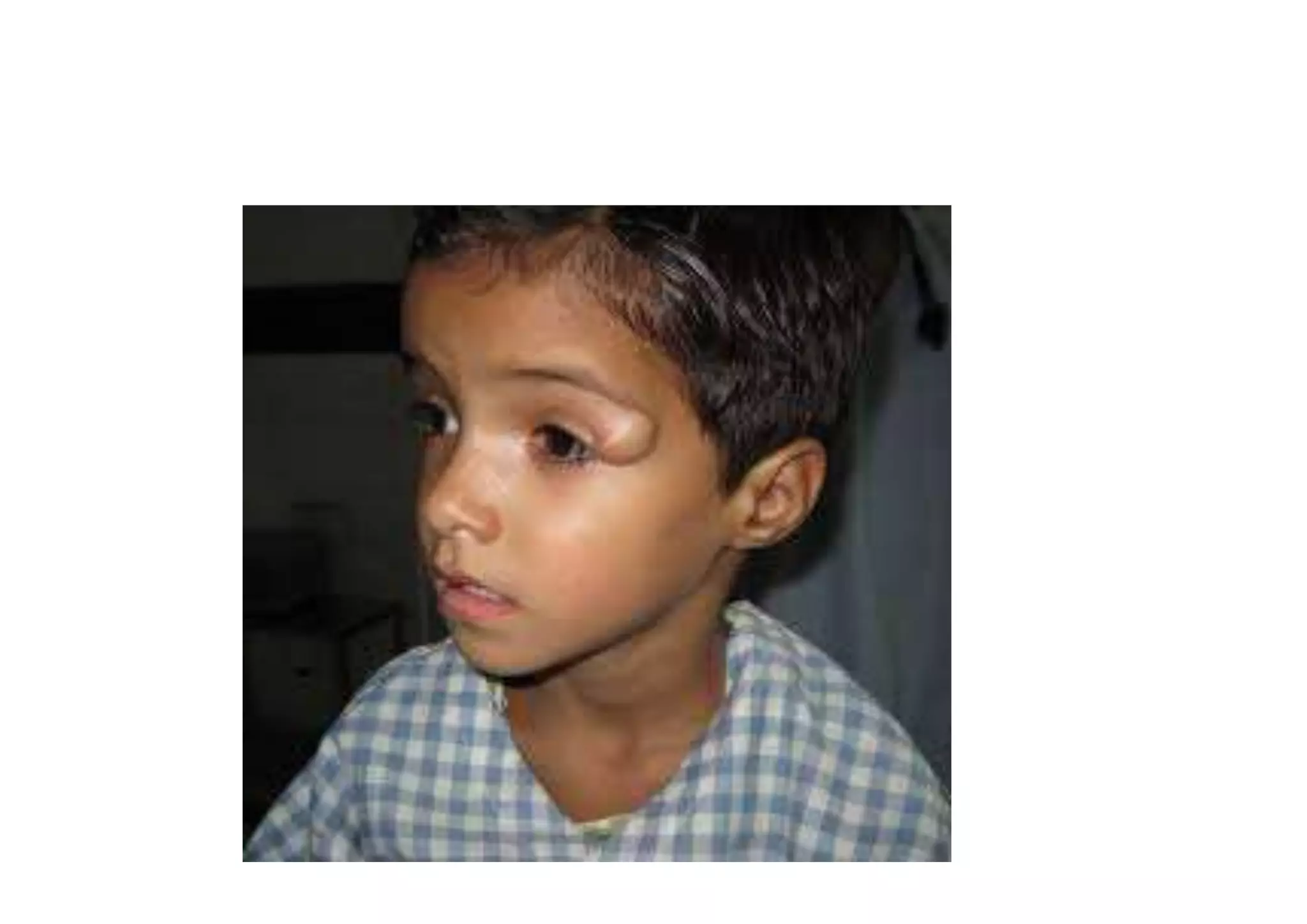 Tumors of the eye | PPT