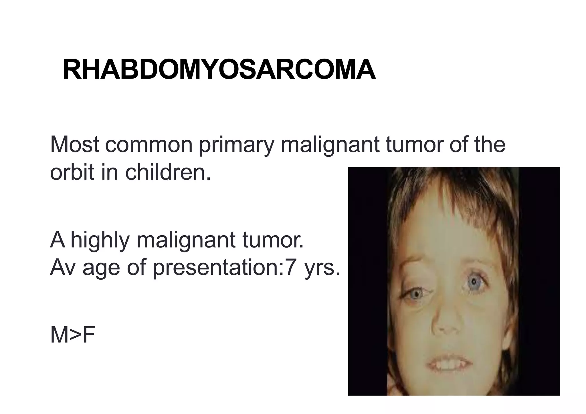 Tumors of the eye | PPT