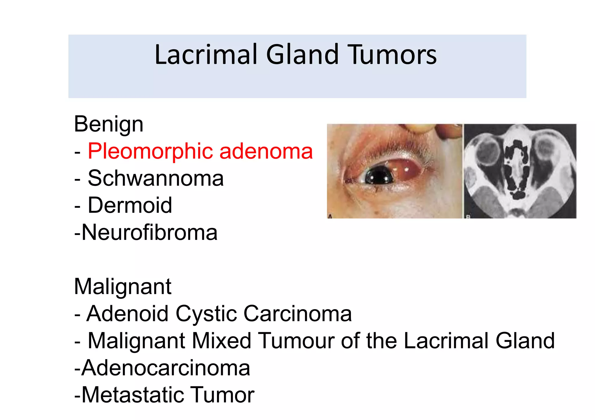 Tumors of the eye | PPT
