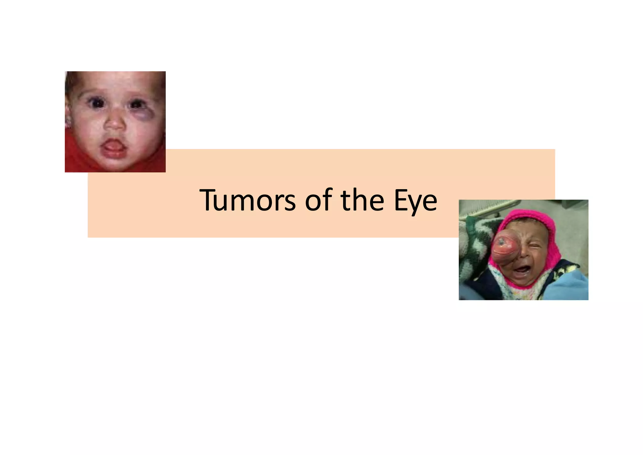 Tumors of the eye | PPT