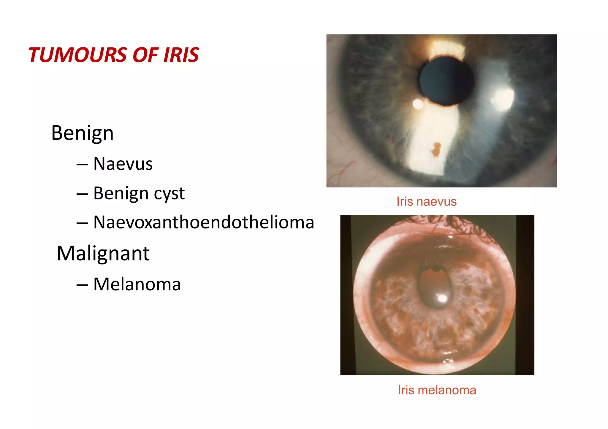 Tumors of the eye | PPT