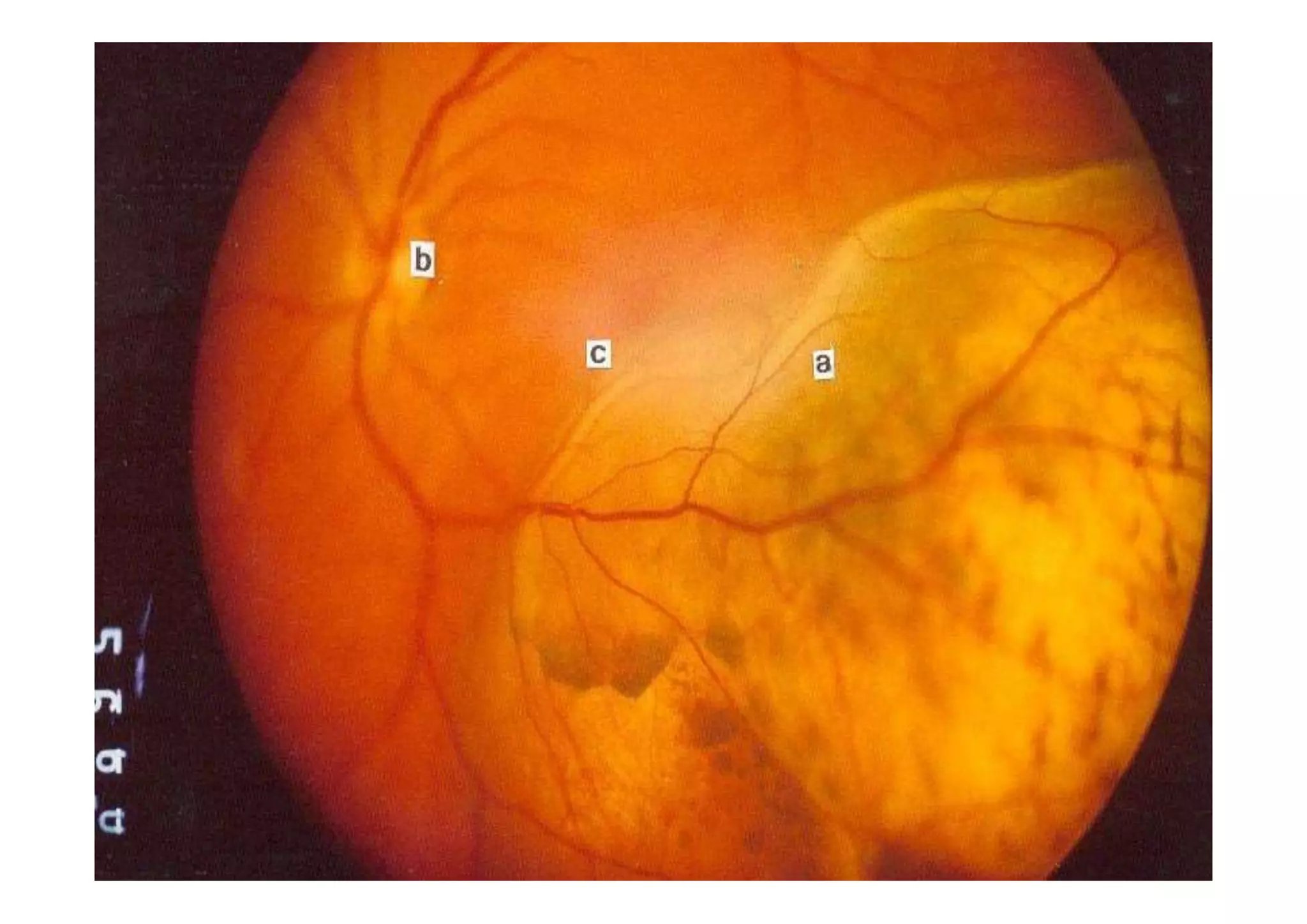 Tumors of the eye | PPT