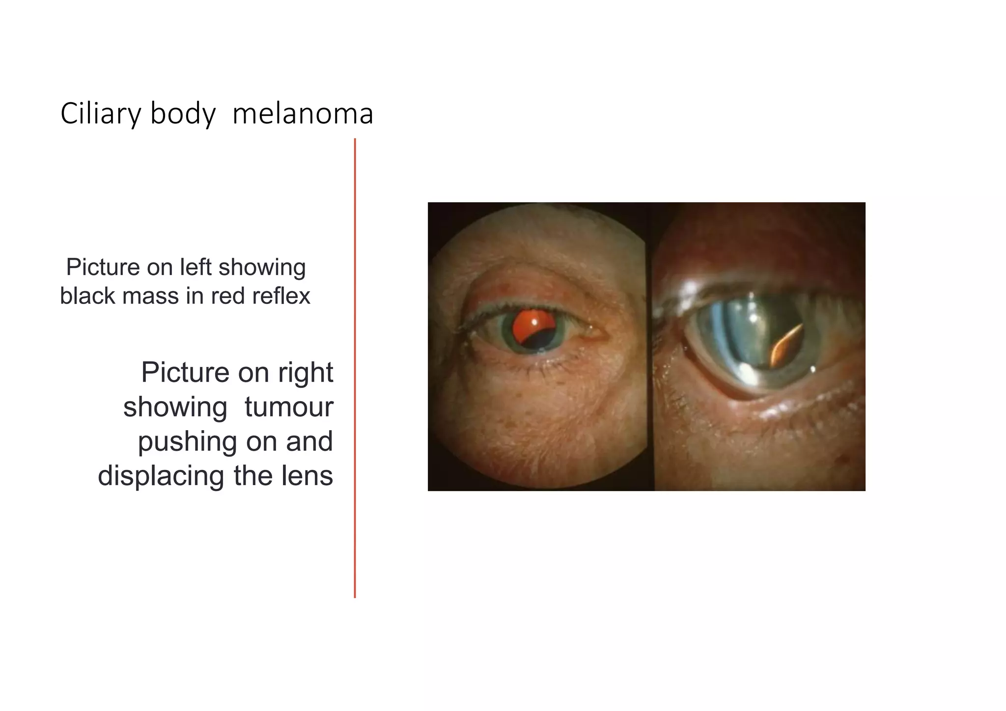Tumors of the eye | PPT