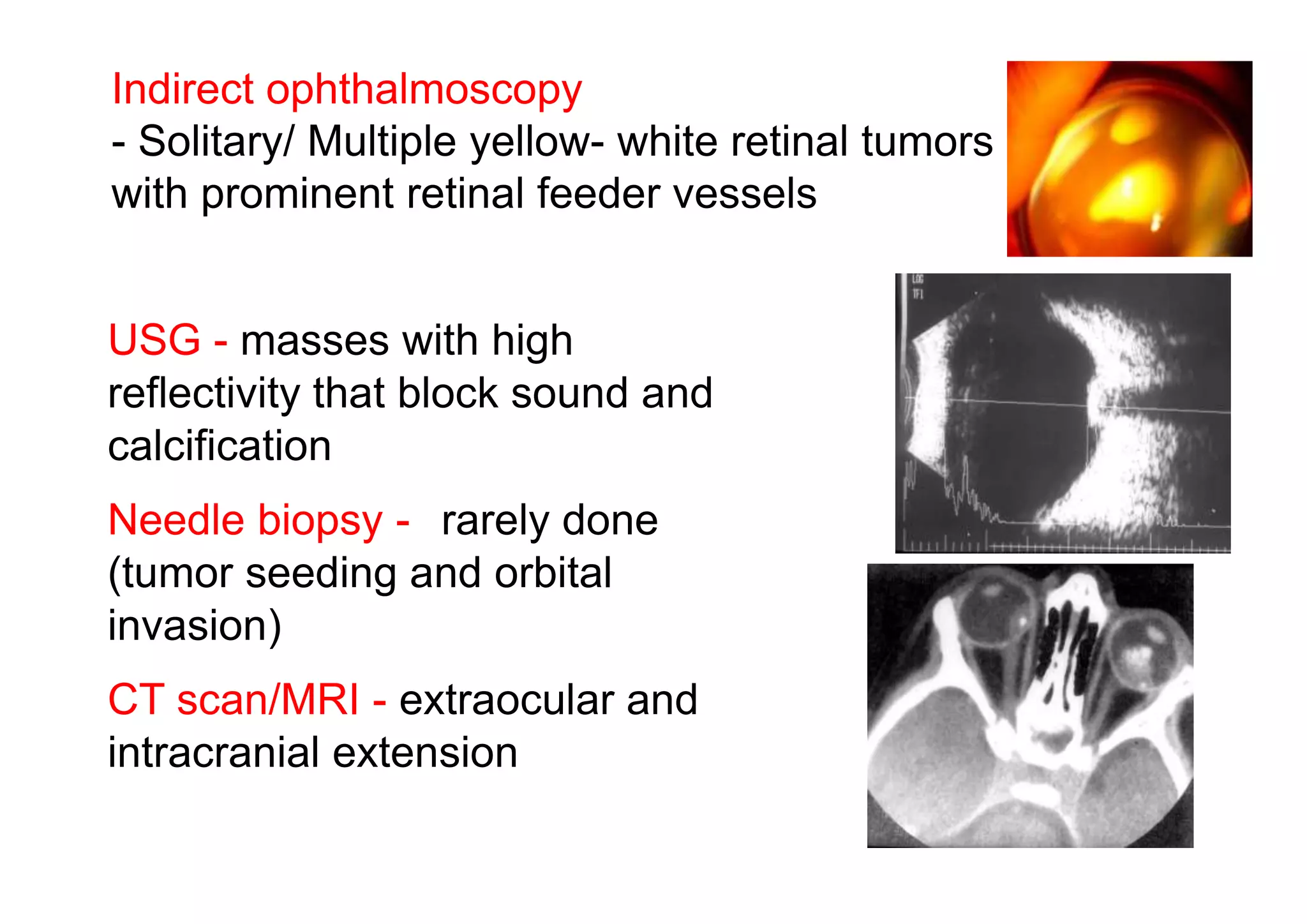 Tumors of the eye | PPT