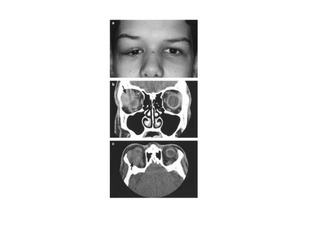 Tumors of the eye | PPT | Eye and Vision Conditions | Diseases and ...
