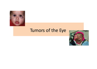 Tumors of the eye | PPT