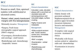 Tumors of the eye | PPT