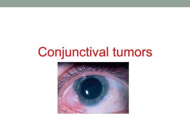 Tumors of the eye | PPT | Eye and Vision Conditions | Diseases and Conditions
