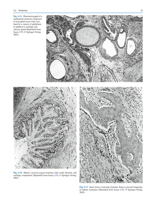 Tumors of the fetus and infant | PDF