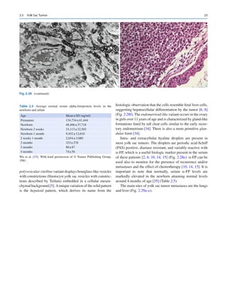 Tumors of the fetus and infant | PDF
