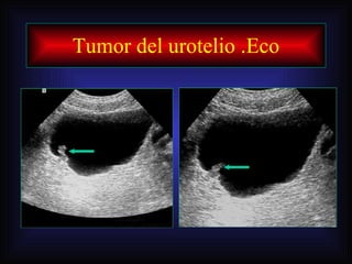 Ultrasonido De Cáncer De Vejiga