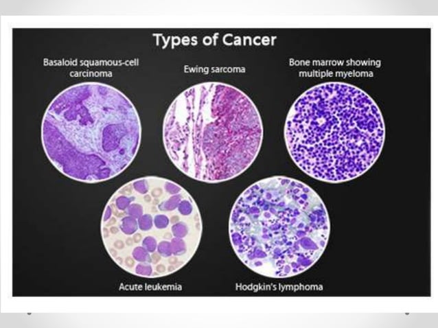Tumour/cancer | PPTX | Blood Disorders | Diseases and Conditions