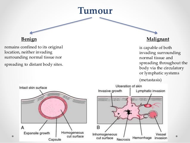 Tumour/cancer