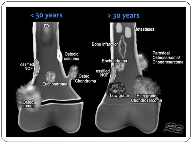 Tumours of bones, cartilage & joints mbbs lect
