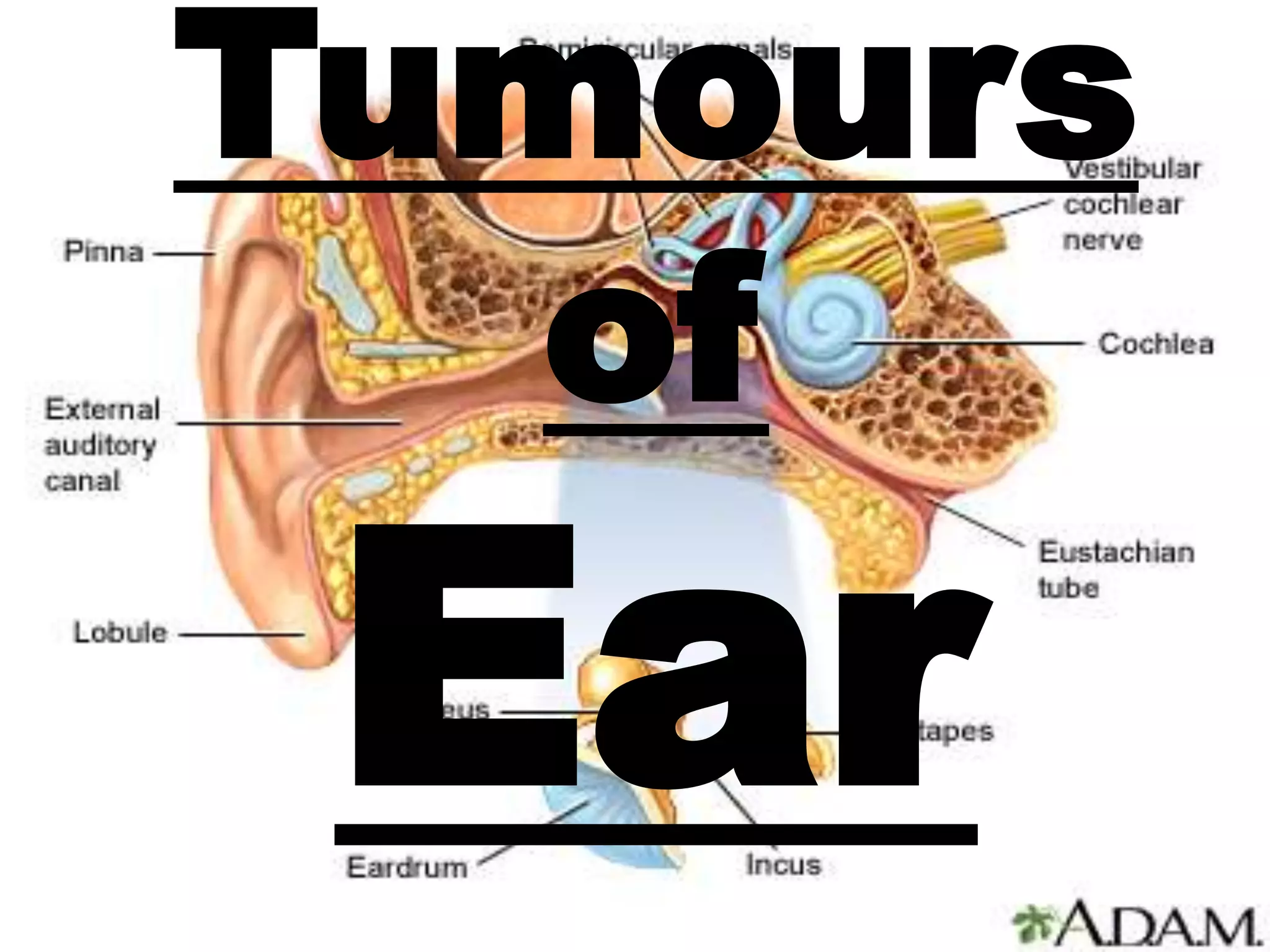 Tumours of Ear | PPTX