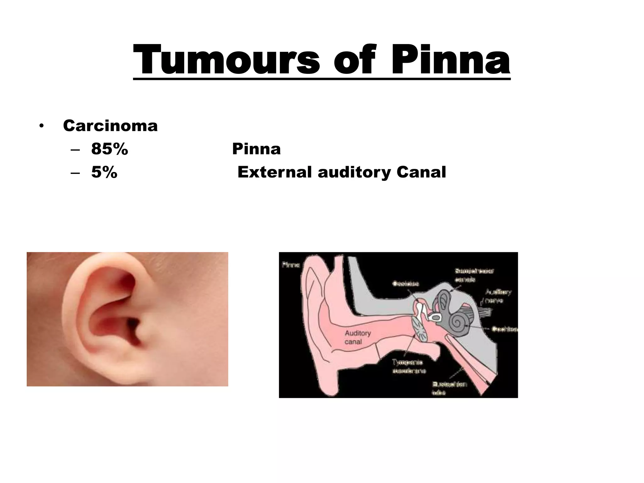 Tumours of Ear | PPTX