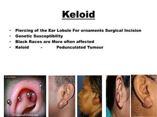 Tumours of Ear | PPTX