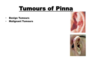 External Ear Tumors