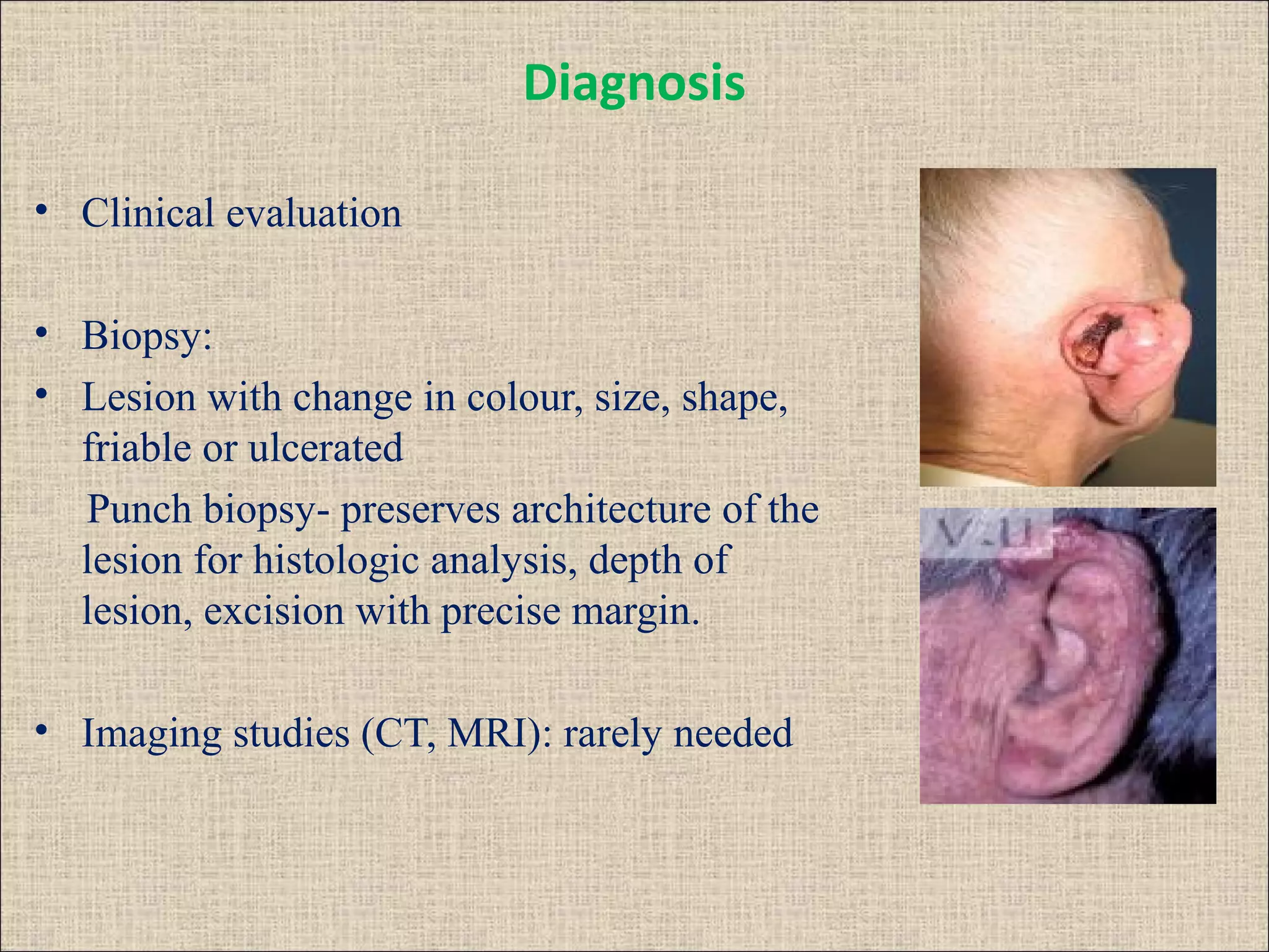 Tumours of external and middle ear | PPT