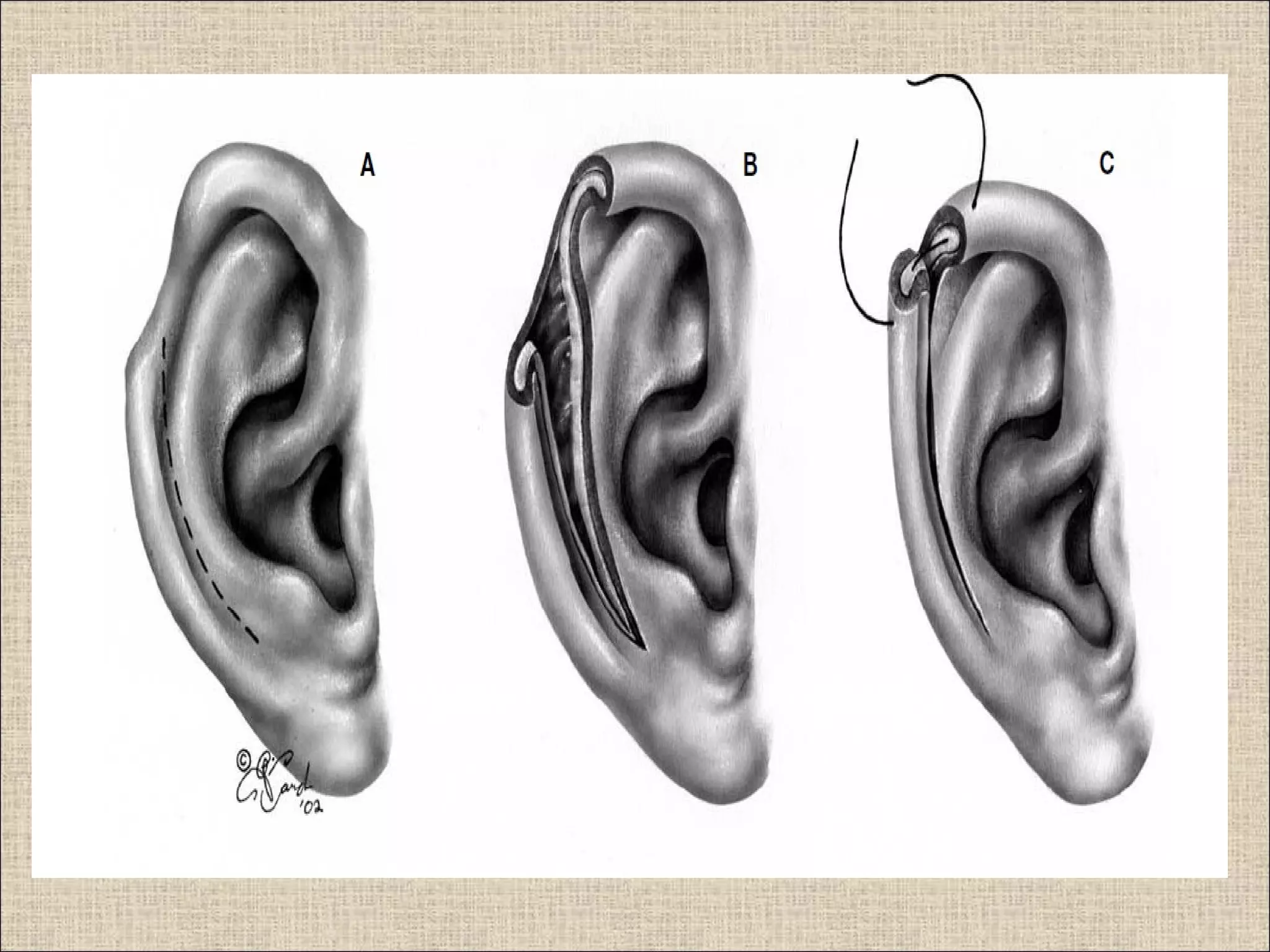 Tumours of external and middle ear | PPT
