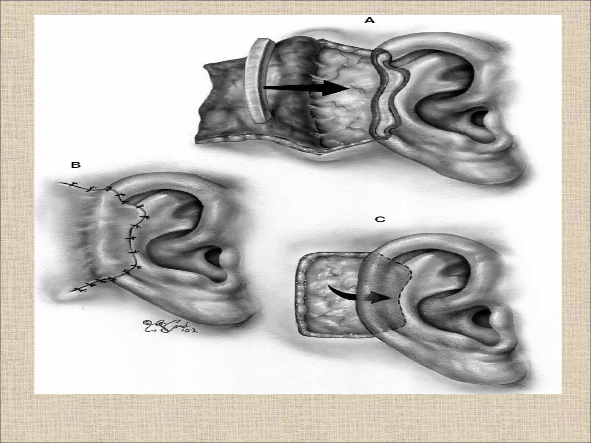 Tumours of external and middle ear | PPT
