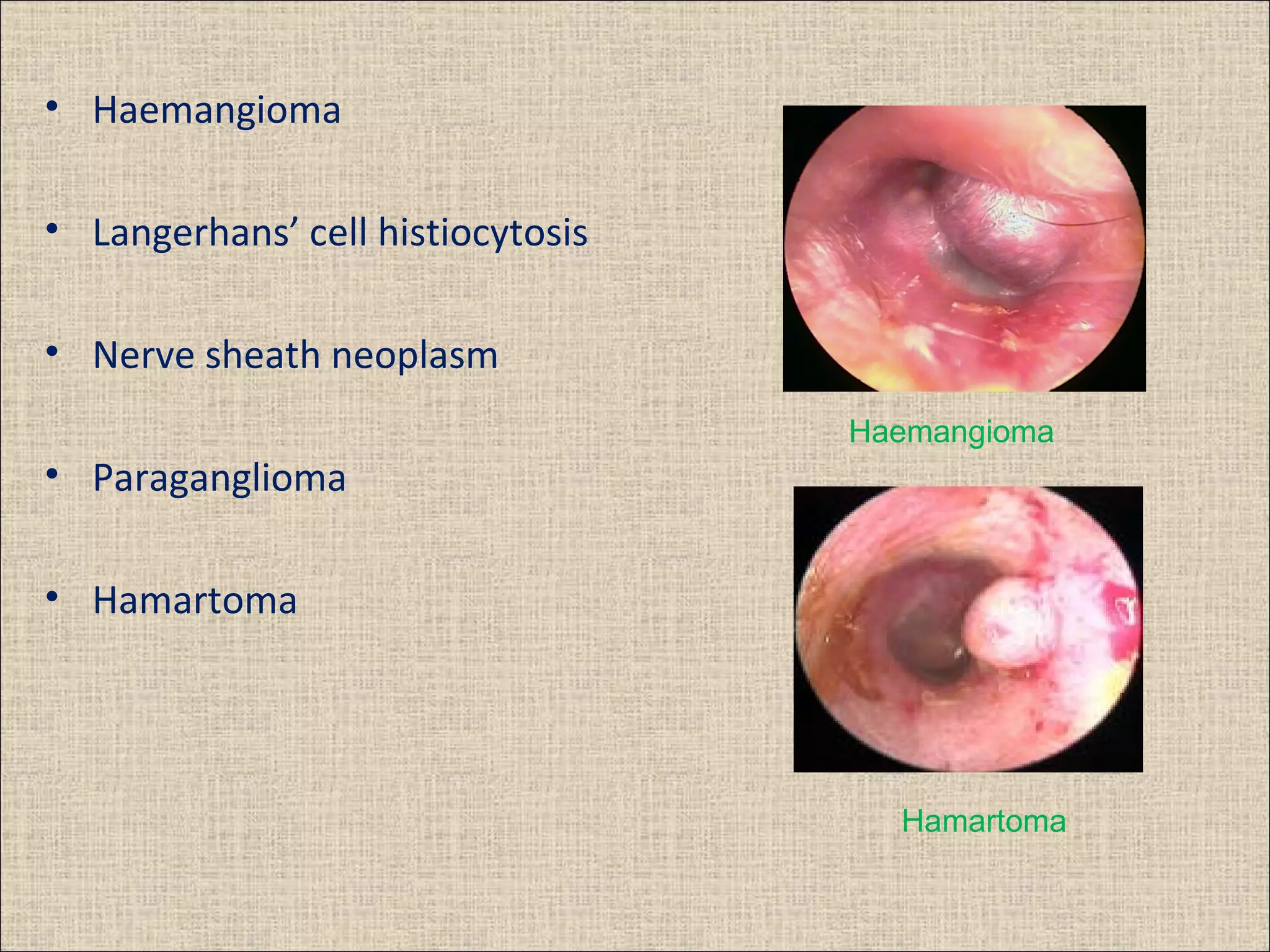 Tumours of external and middle ear | PPT