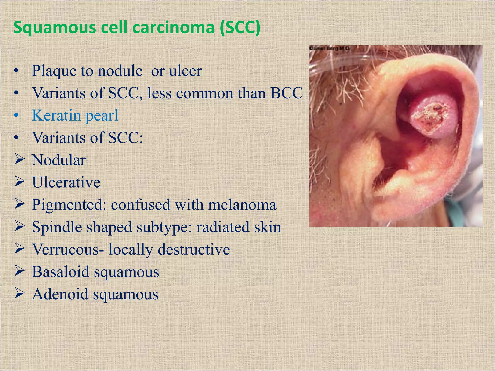 Tumours of external and middle ear | PPT