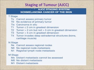 Ear Cancer Staging