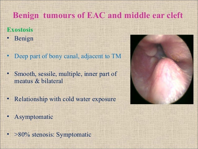 Glomus Tumor Ear