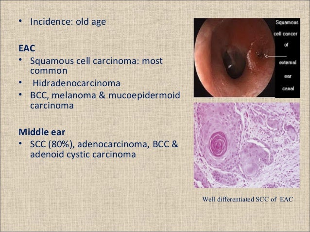 Tumours of external and middle ear