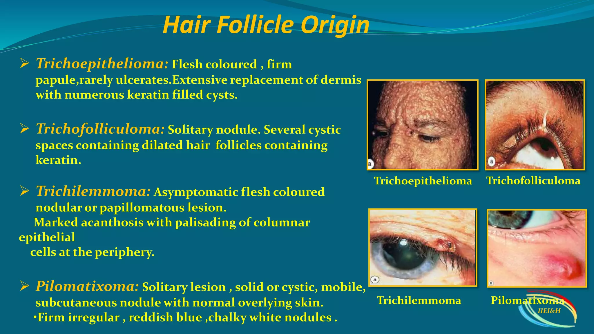 Tumours of eyelid | PPTX