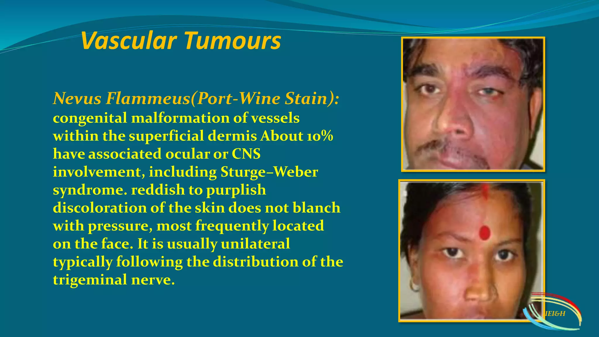 Tumours of eyelid | PPTX