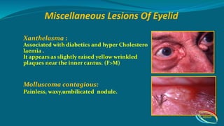 Tumours of eyelid | PPTX