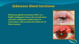 Tumours of eyelid | PPTX