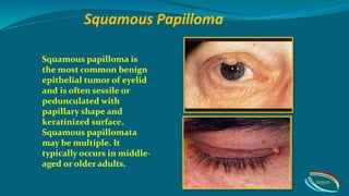 Tumours of eyelid | PPTX