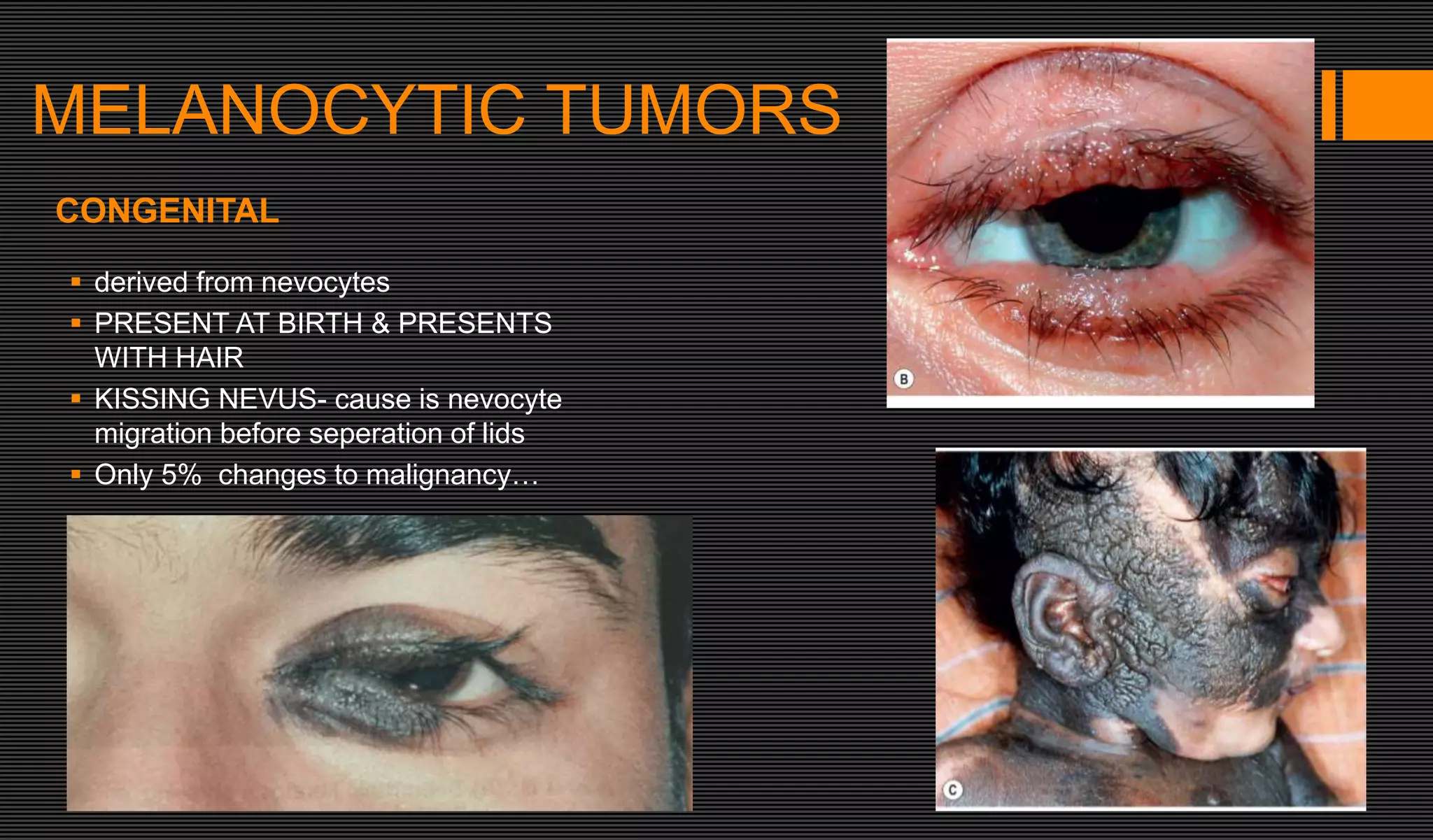 Tumours of eyelids | PPTX