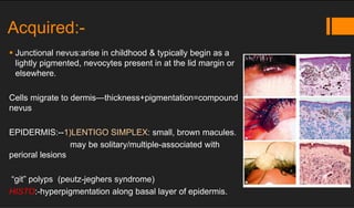 Tumours of eyelids | PPTX