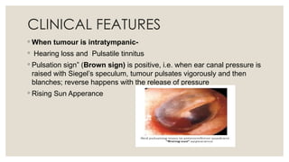 Tumours of middle ear Tumours of middle ear.pptx
