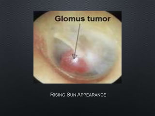 Tumours of middle ear and mastoid.pptx