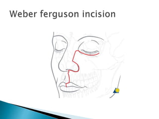 Tumours of nose and pns | PPTX
