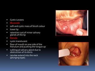 Tumours of oral cavity | PPTX