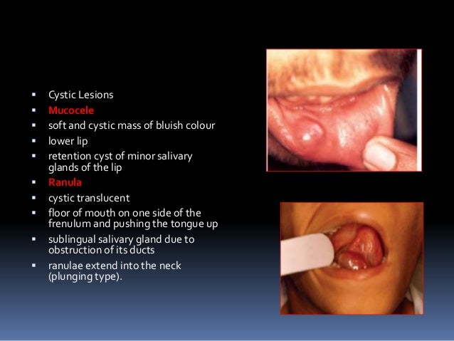 Traumatic Injuries To The Parotid Gland And Duct Journal Of Oral And