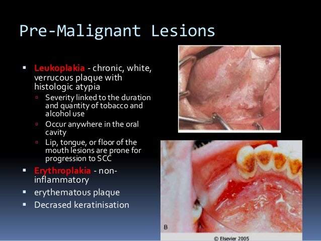 Inflammatory And Reactive Lesions Of The Oral Mucosa Red Lesions Of