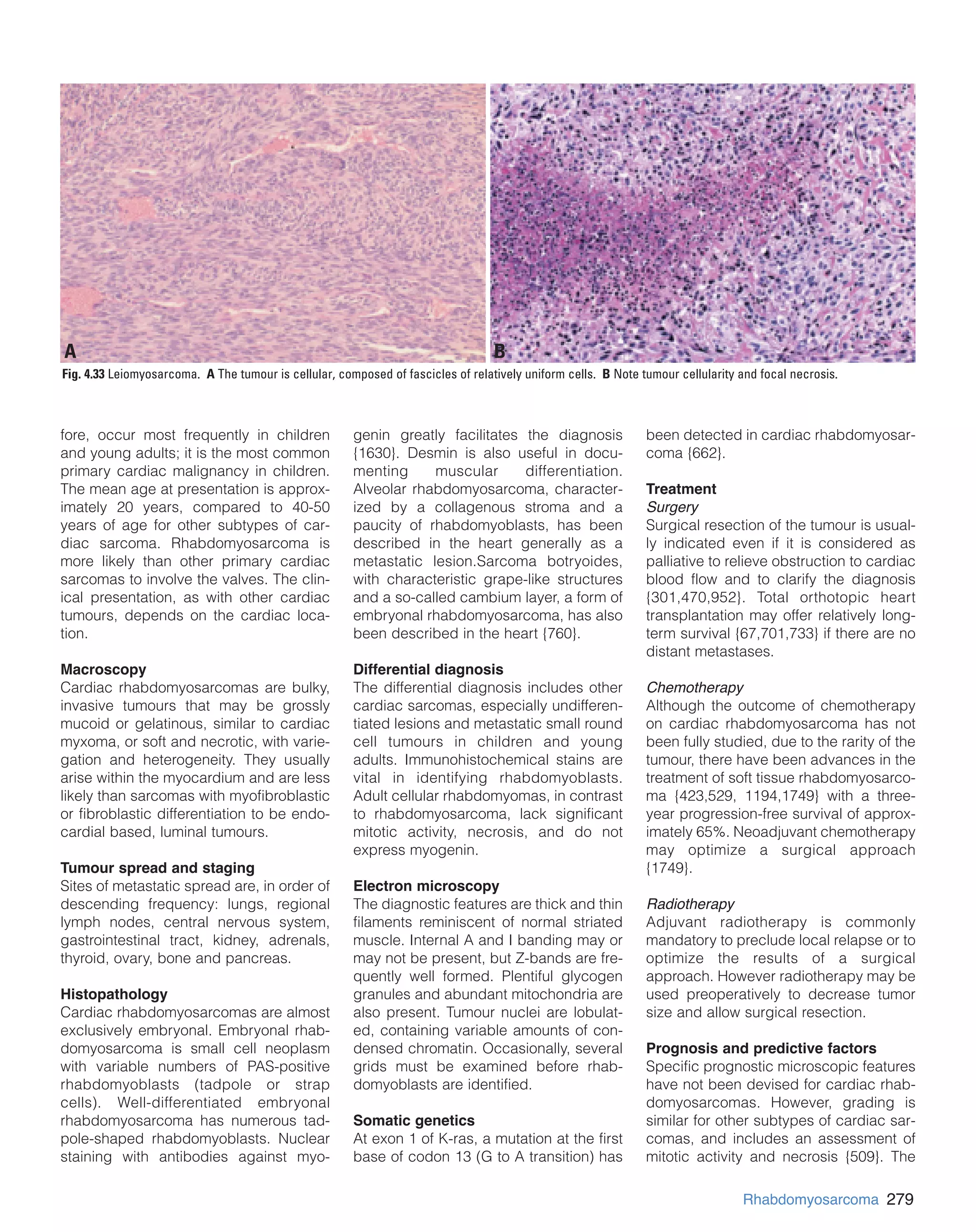 Tumours of the heart | PDF